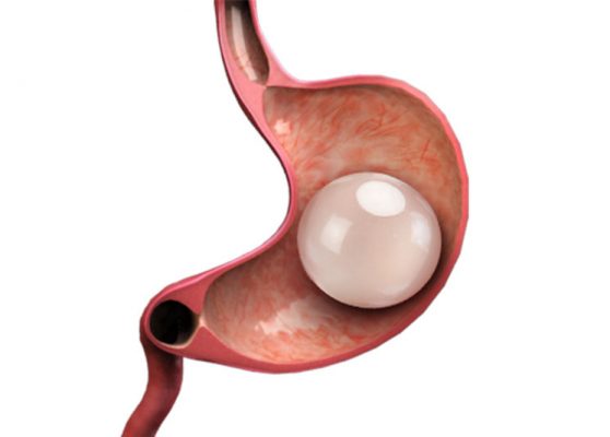 5 Benefits of Orbera Balloon Surgery: - MY Healthy Life Vision